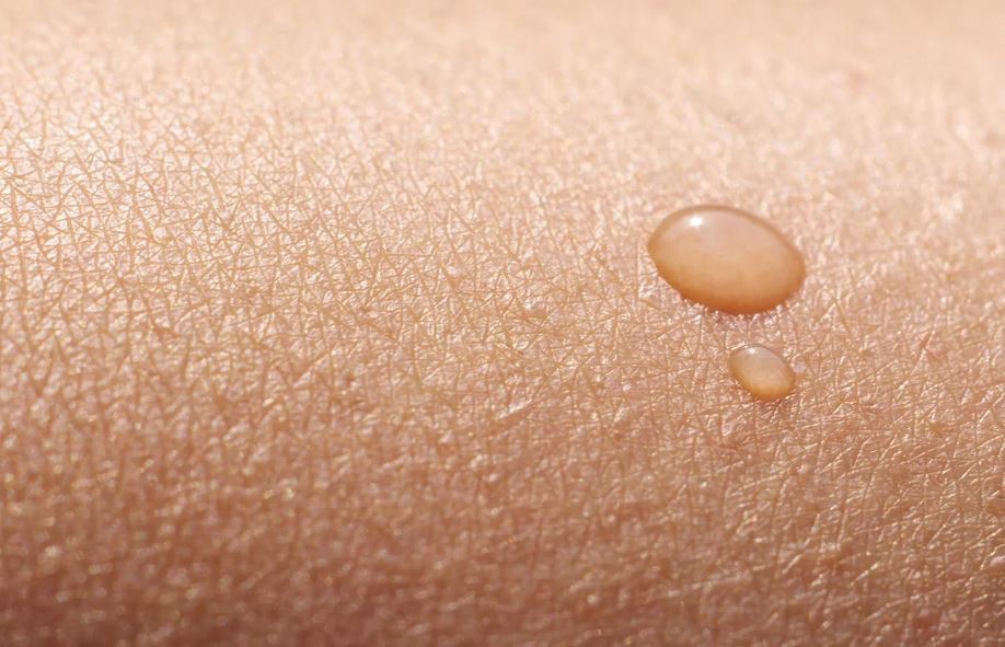 What You Need to Know About Hard Water and Skin Issues - Passaic Bergen ...